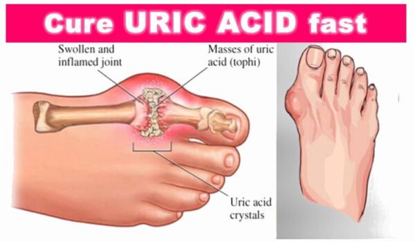 Decrease Your Uric Acid Levels With Top 7 Home Remedies