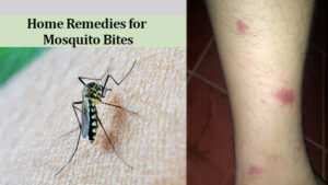 9 Home Remedies for Mosquito Bites-Stop Itching Fast