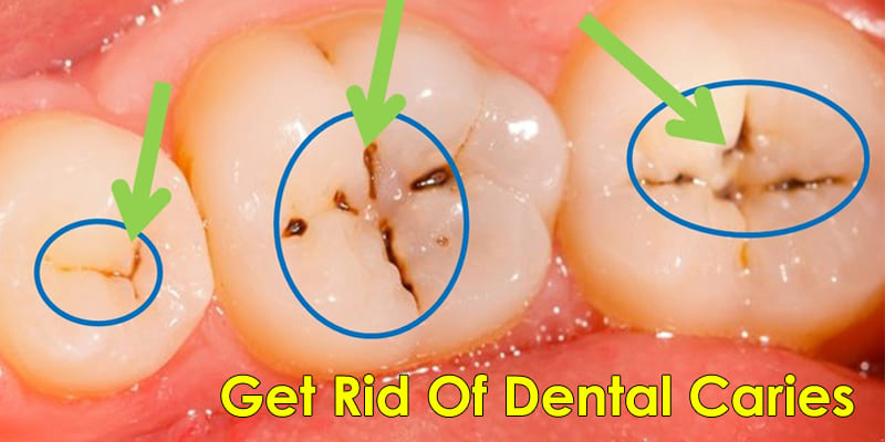 How to Heal Tooth Decay and Reverse Cavities in 2 Days