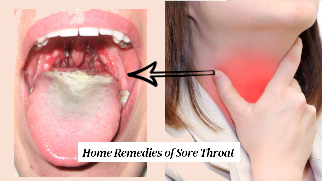 Sore Throat Cure Home Remedies Of Sore Throat To Get Instant Relief