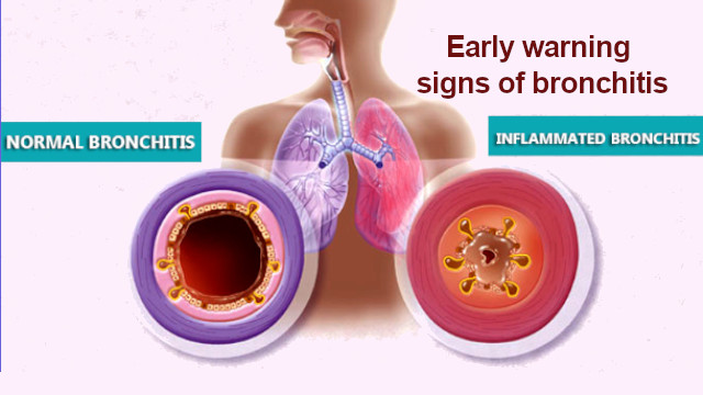 Bronchitis Prevention: How to get rid of Bronchitis Without Antibiotics!