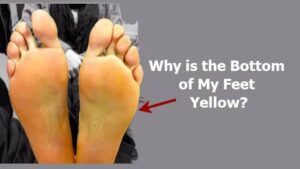 Bottoms of Feet Yellow: Why is the Bottom of My Feet Yellow?